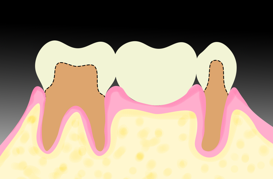 Crown, Bridges and Veneers – Dr. E. Y. Choi Dental Office